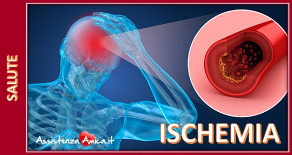 Ischemia: cos’è, cause, conseguenze, rischi, cure - Assistenza Amica